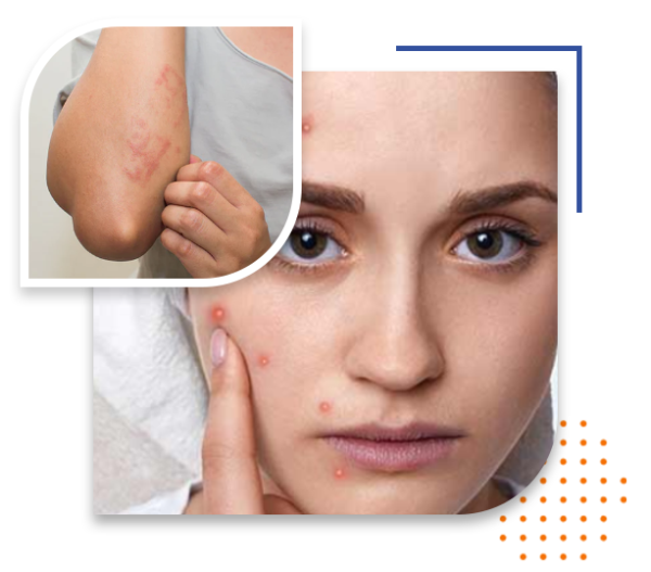 Bacterial Skin Infections : Causes, Types, Treatments & Prevention
