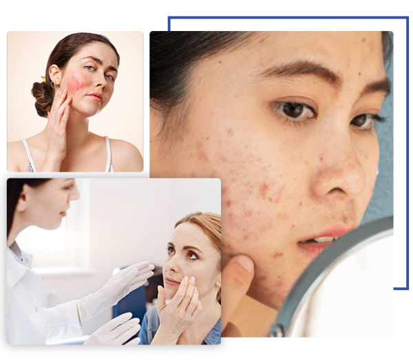Acne : Causes, Types, Treatments & Prevention