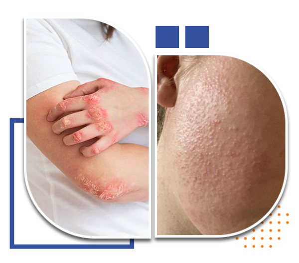 Fungal Infections : Causes, Types, Treatments & Prevention