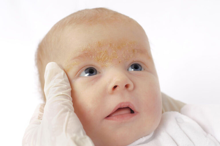 Seborrheic Dermatitis : Causes, Types, Treatments & Prevention
